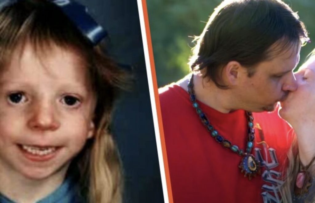 Man Marries Woman Called ‘Ugly’ for Deformed Face Yet ‘Most Beautiful ...