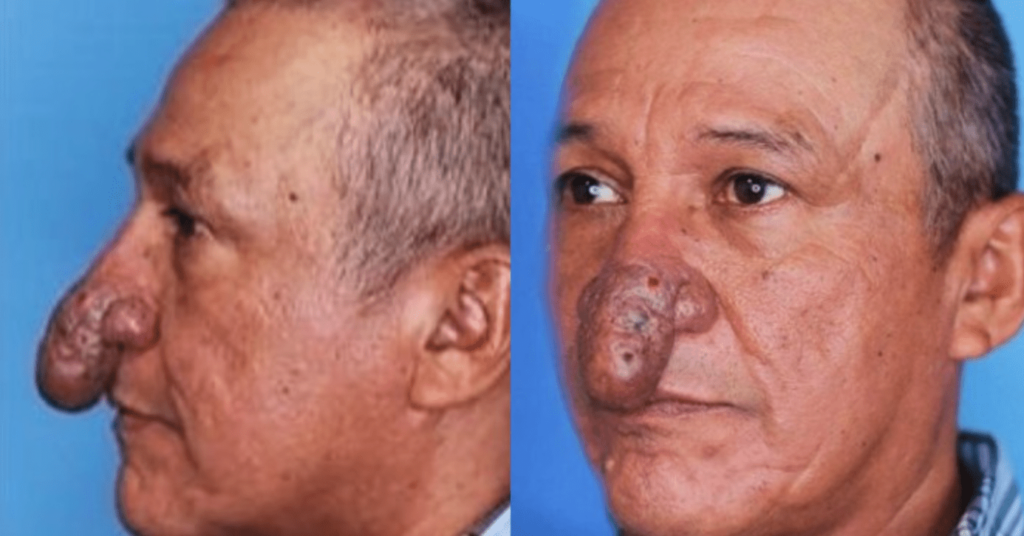 The Remarkable Transformation of Conrado’s Nose | LOLitopia